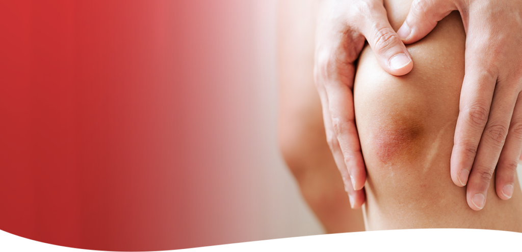 How To Avoid Bruising Easily Hirudoid how-to-avoid-bruising-easily-hirudoid